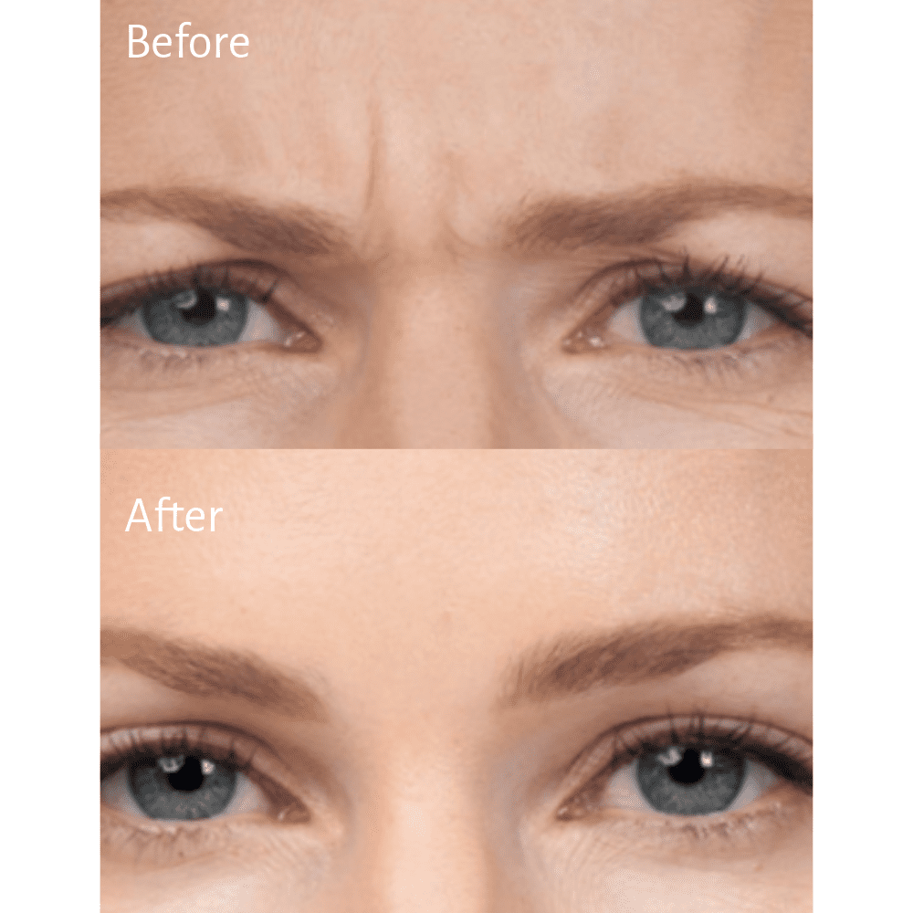 Botox Transformations: Before and After Photo Gallery