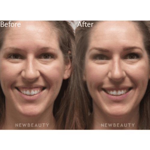 Botox Transformations: Before and After Photo Gallery