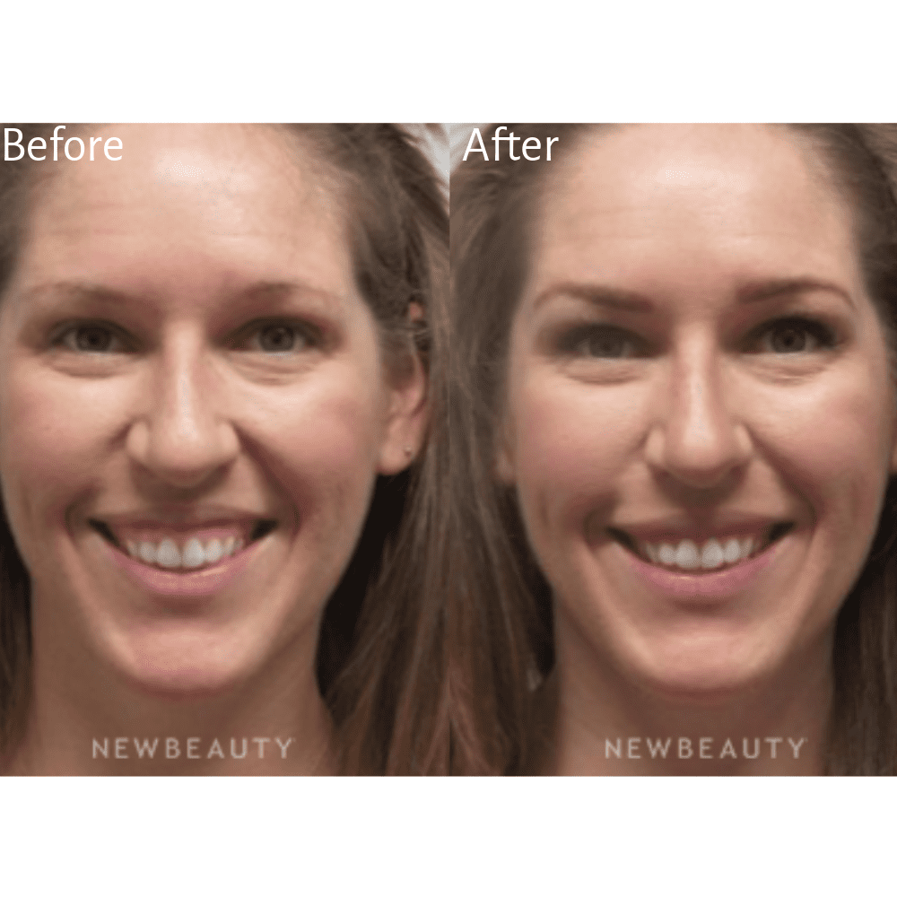 Botox Transformations: Before and After Photo Gallery