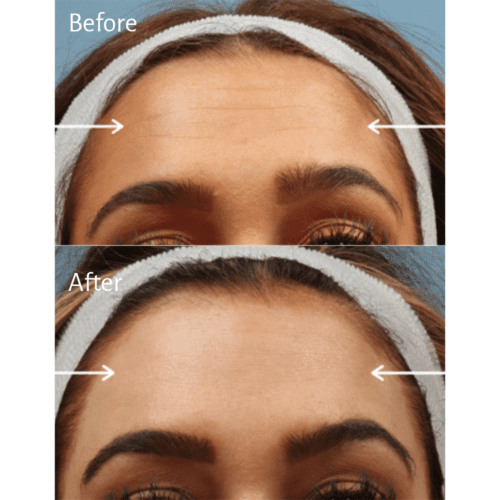 Botox Transformations: Before and After Photo Gallery