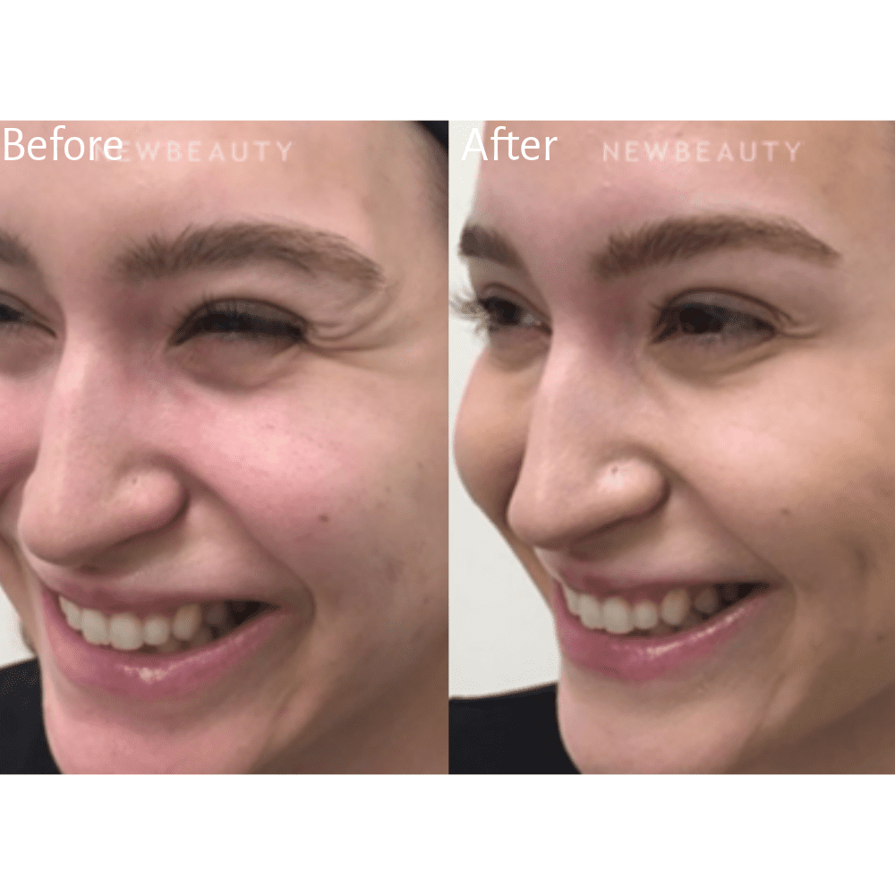 Botox Transformations: Before and After Photo Gallery