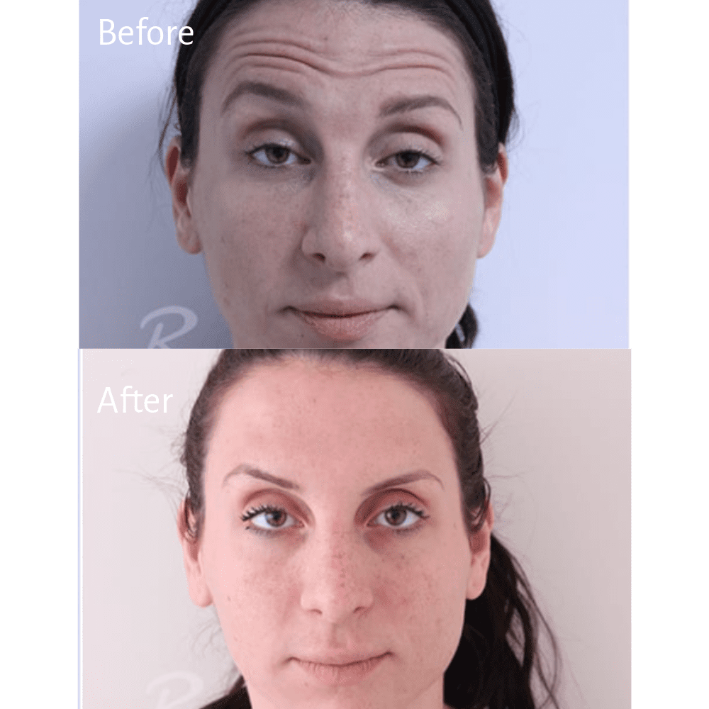 Botox Transformations: Before and After Photo Gallery