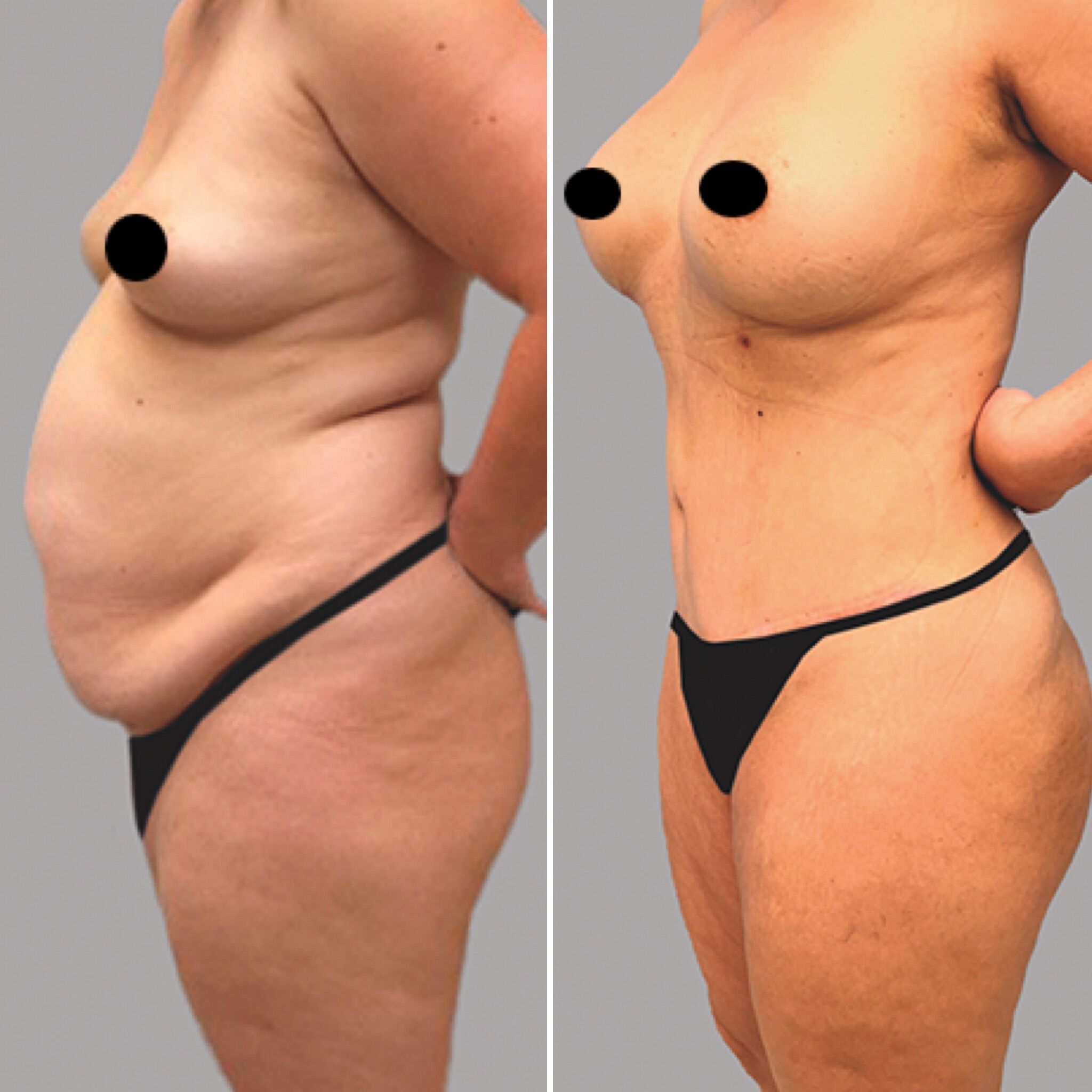 Tummy Tuck Before And After Photos Real Patient Results 4538