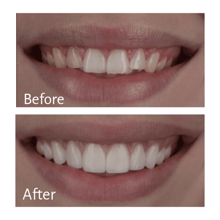 See Amazing Veneers Before-and-After Photos