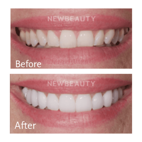 See Amazing Veneers Before-and-After Photos