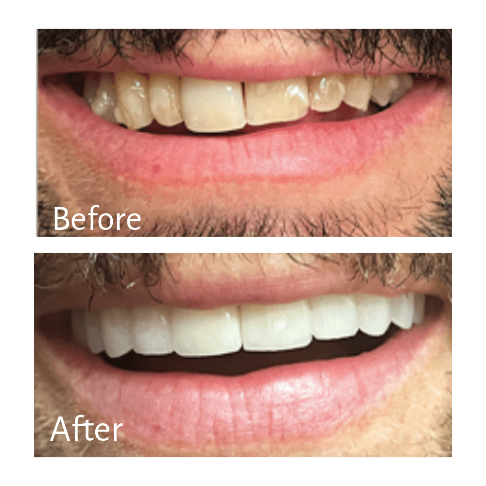 See Amazing Veneers Before-and-After Photos