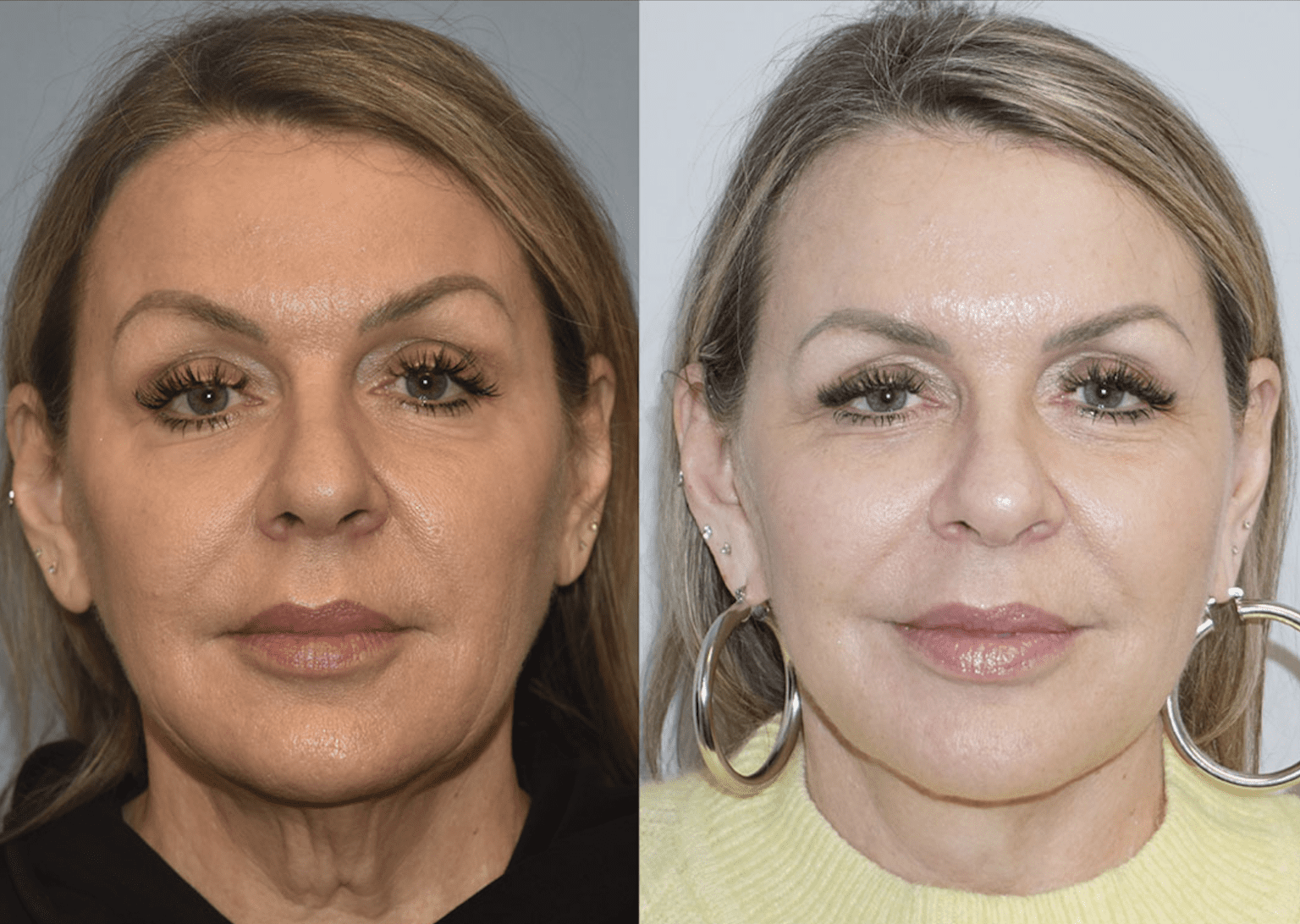 Why I Decided On a Facelift After Years of Nonsurgical Treatments